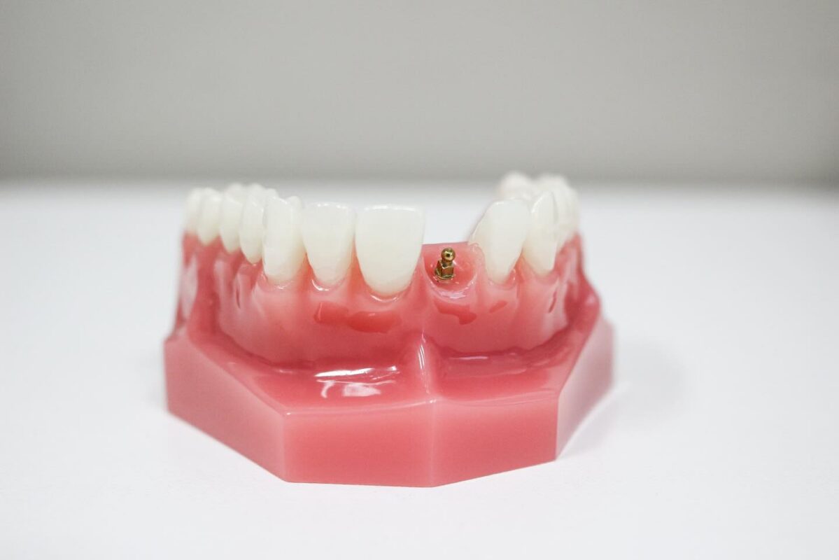 Best Implant Options in 2026 in Winston-Salem, NC [Video Q&A]